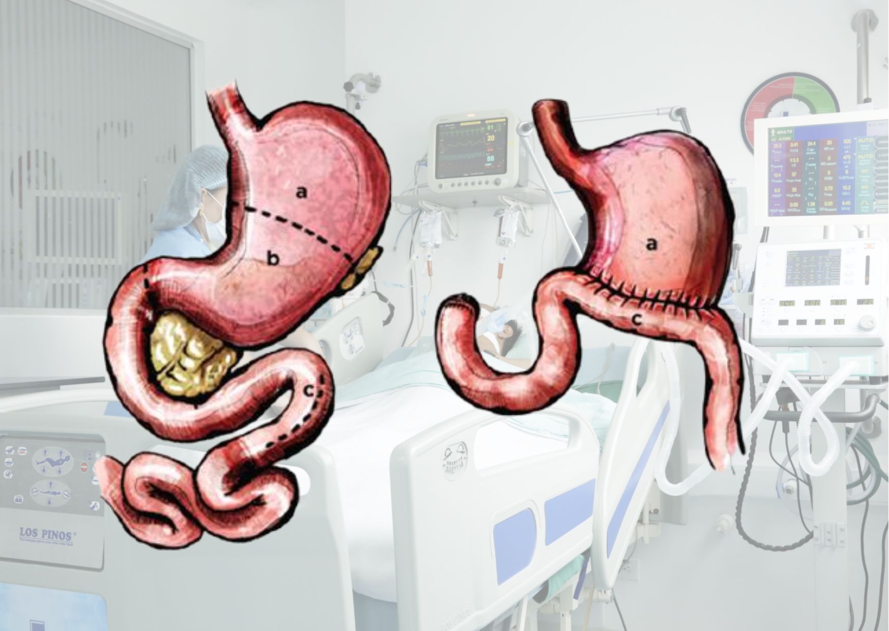 Demolición abdominal y esofagoyeyunoanastomosis en paciente con ...